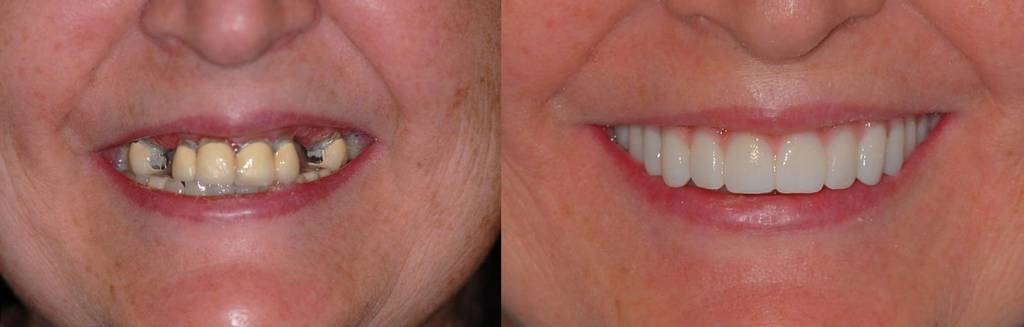 Before & After - ReNew Dental Dentures & Implants